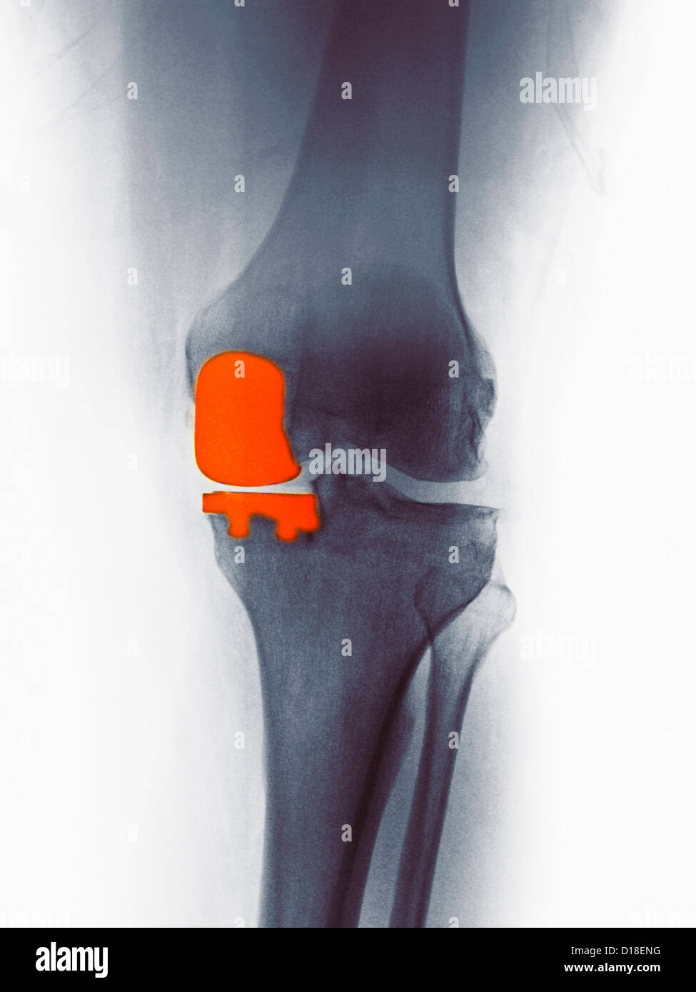 Knee replacement x ray hi-res stock photography and images - Alamy