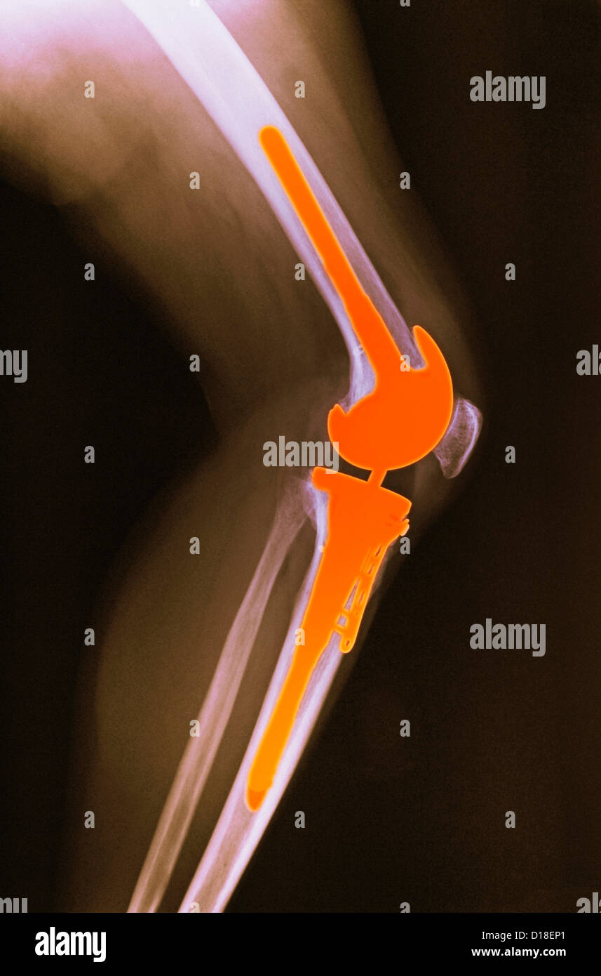Total knee replacement hi-res stock photography and images - Alamy
