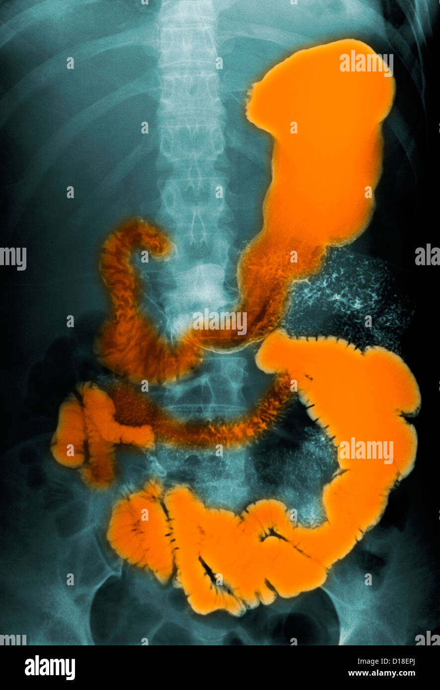 Small bowel intestine hi-res stock photography and images - Alamy