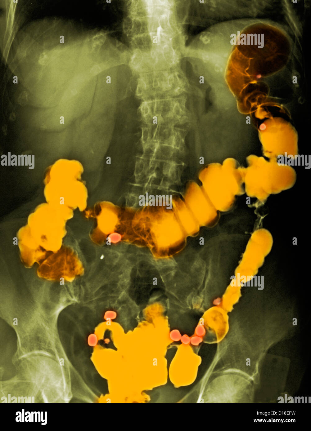 Diverticulosis of colon hi-res stock photography and images - Alamy