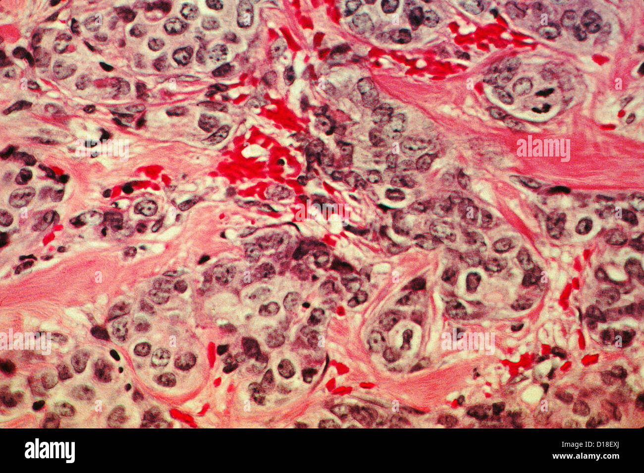 Histological slide of cancerous breast tissue Stock Photo - Alamy