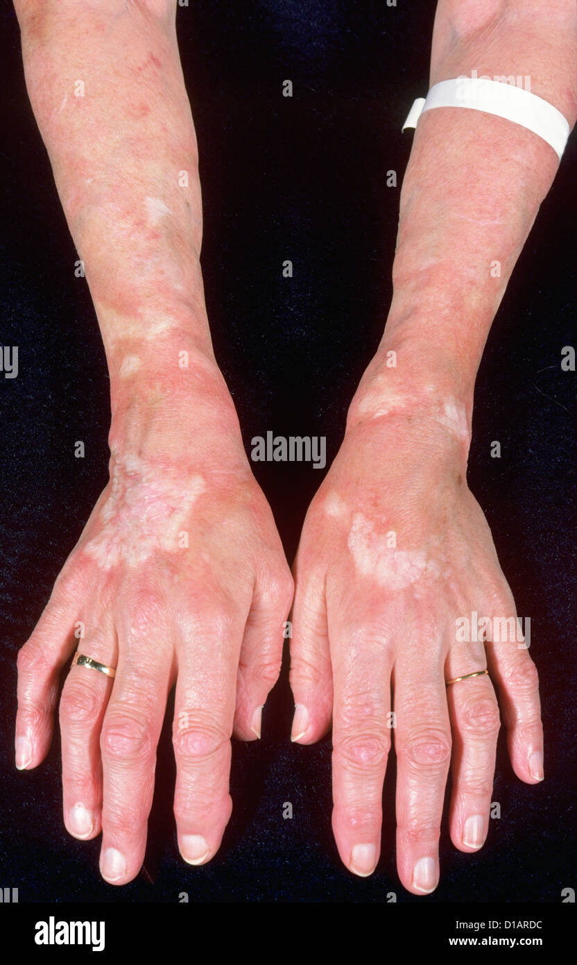 Dermatosclerosis hi-res stock photography and images - Alamy