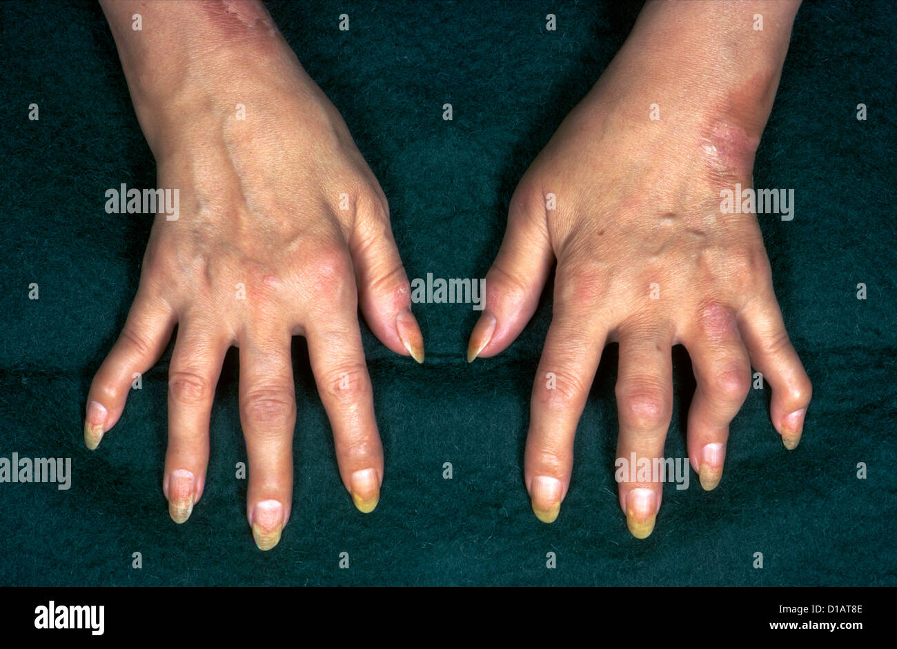Psoriatic arthritis hi-res stock photography and images - Alamy