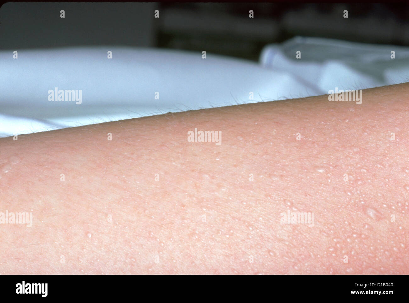 BLISTERS Stock Photo: 52487344 - Alamy