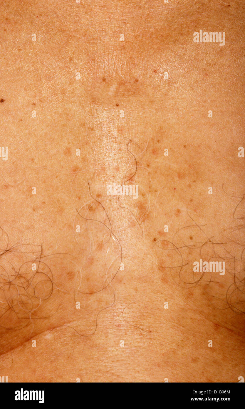 Hyperpigmentation hi-res stock photography and images - Alamy