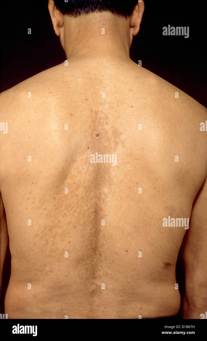 Hyperpigmentation hi-res stock photography and images - Alamy