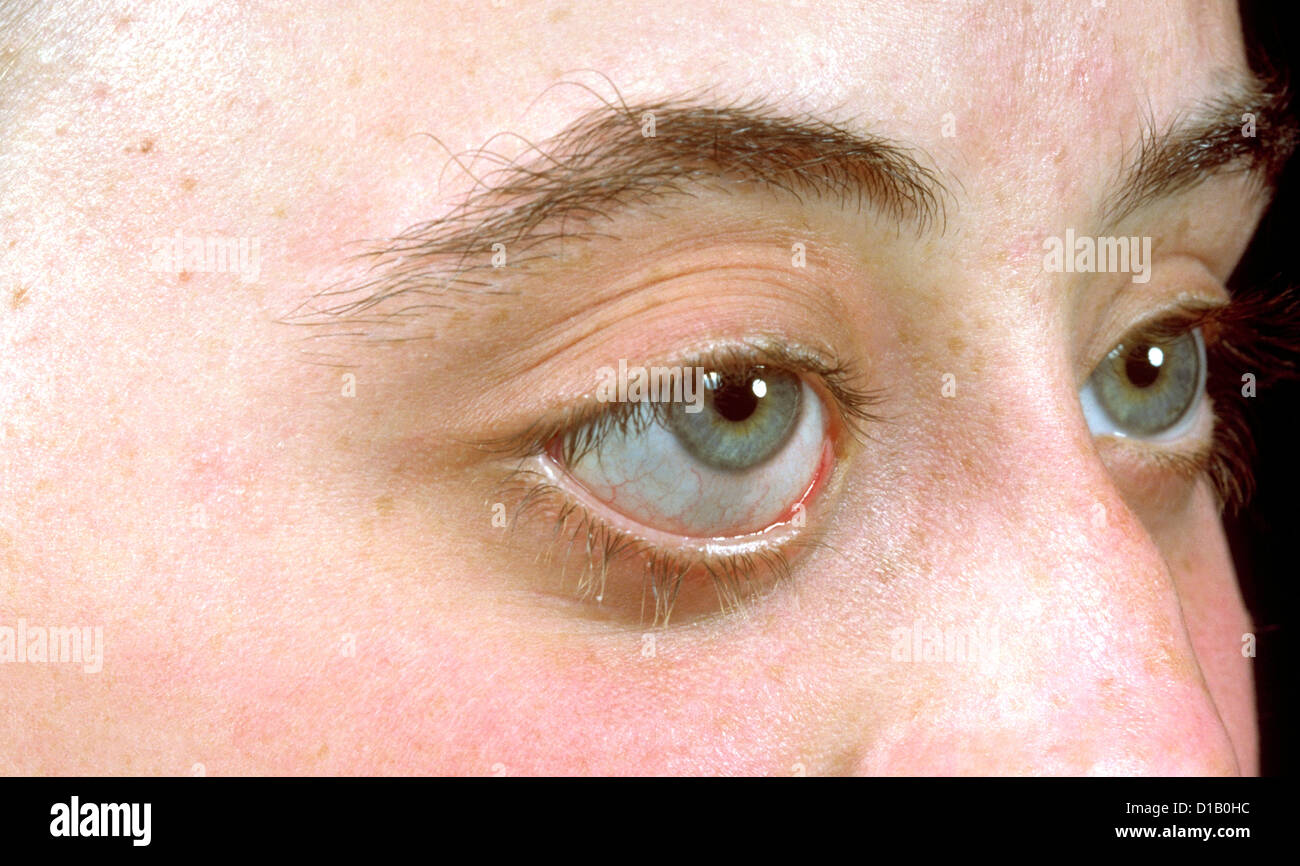 Exophthalmos In Children