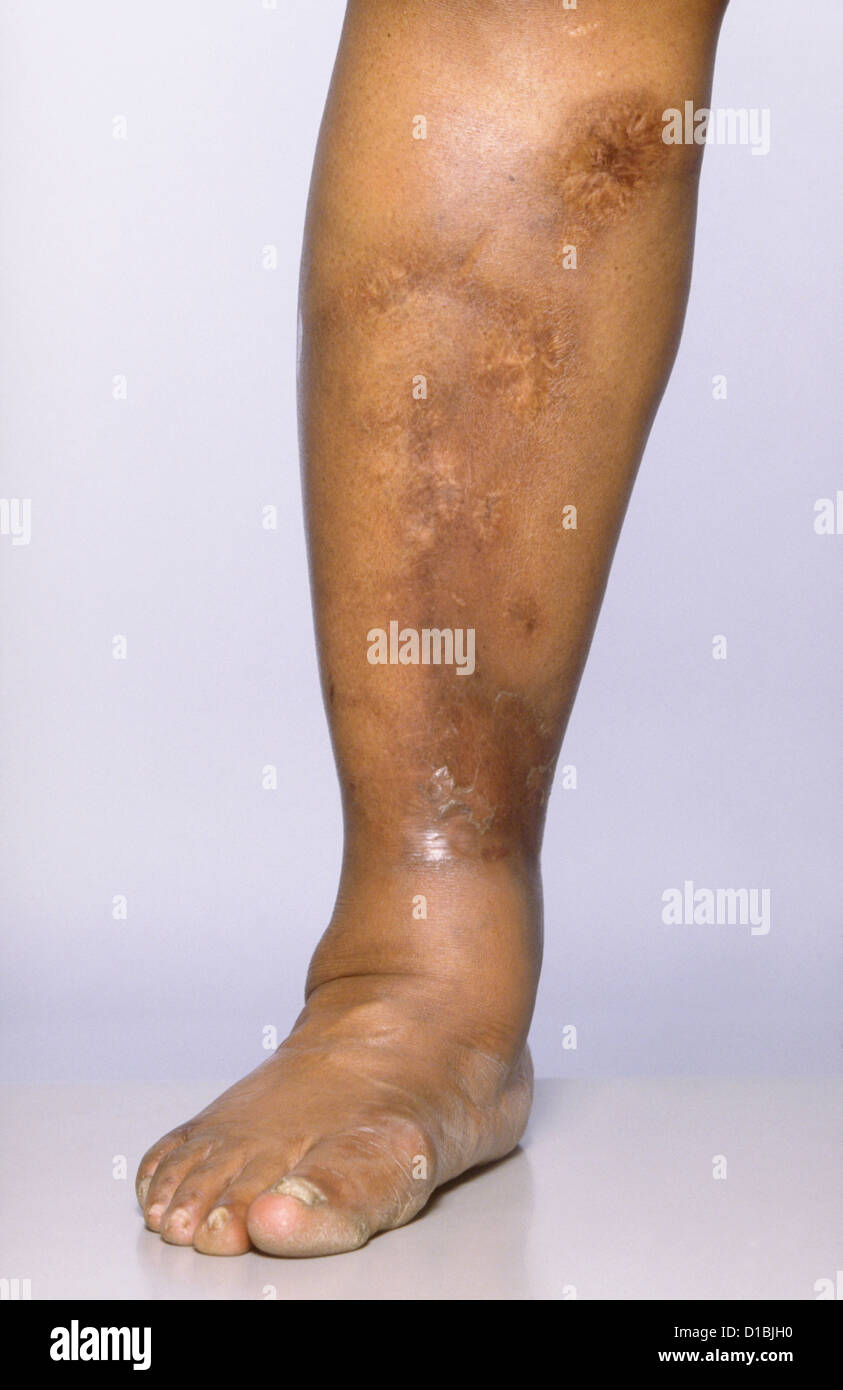 Lichen Sclerosus Et Atrophicus