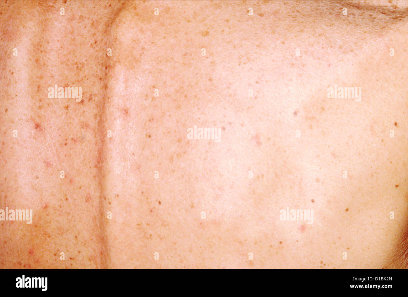 FOLLICULITIS AND WASTING IN HIV POSITIVE PATIENT Stock Photo - Alamy