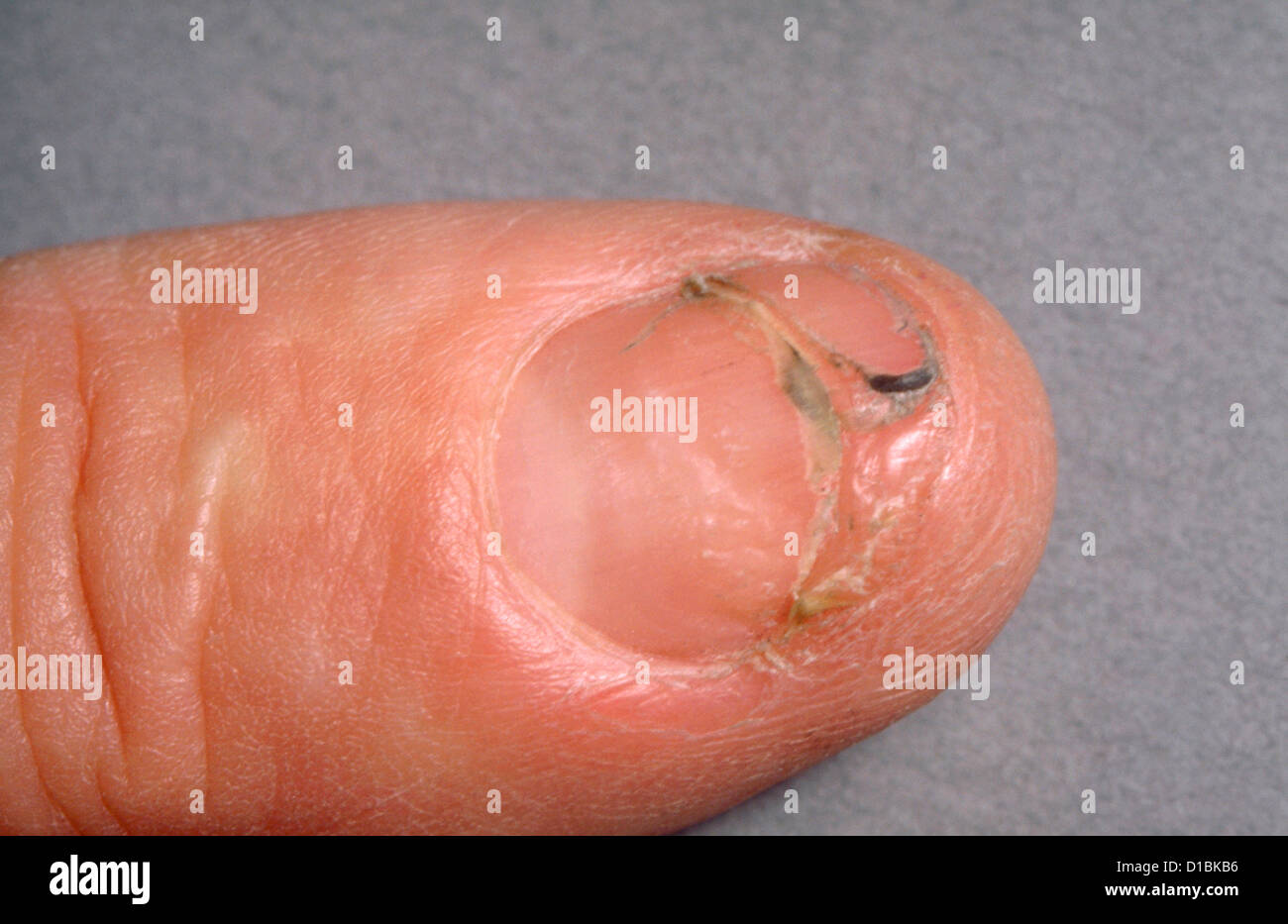 Beau S Lines Ridges In Fingernails: Causes And Treatments Riverchase