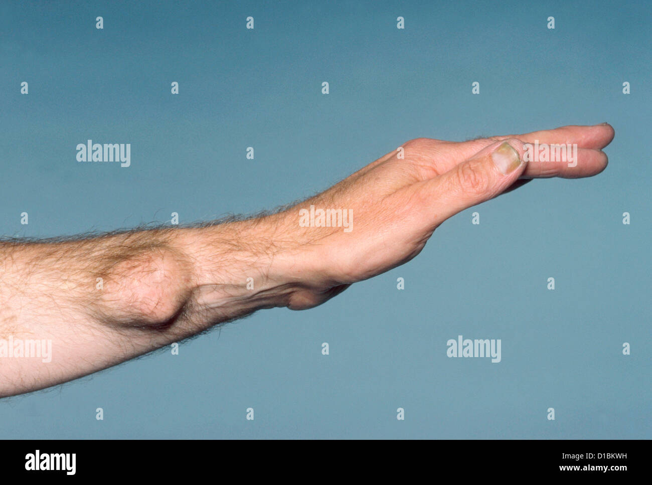 CALCIFIED AND THROMBOSED ARTERIOVENOUS FISTULA - ARM Stock Photo - Alamy