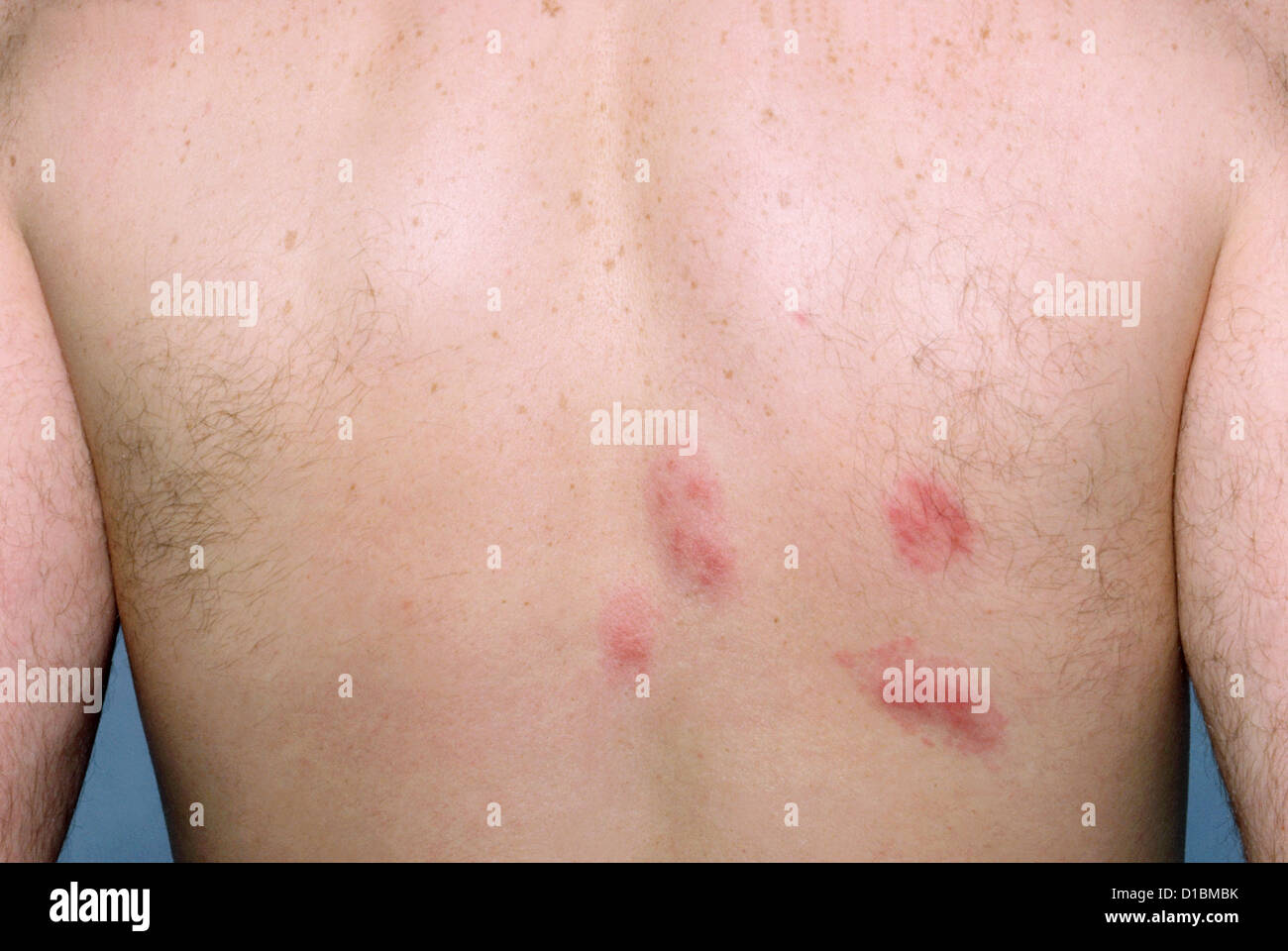 Herpes On Lower Back