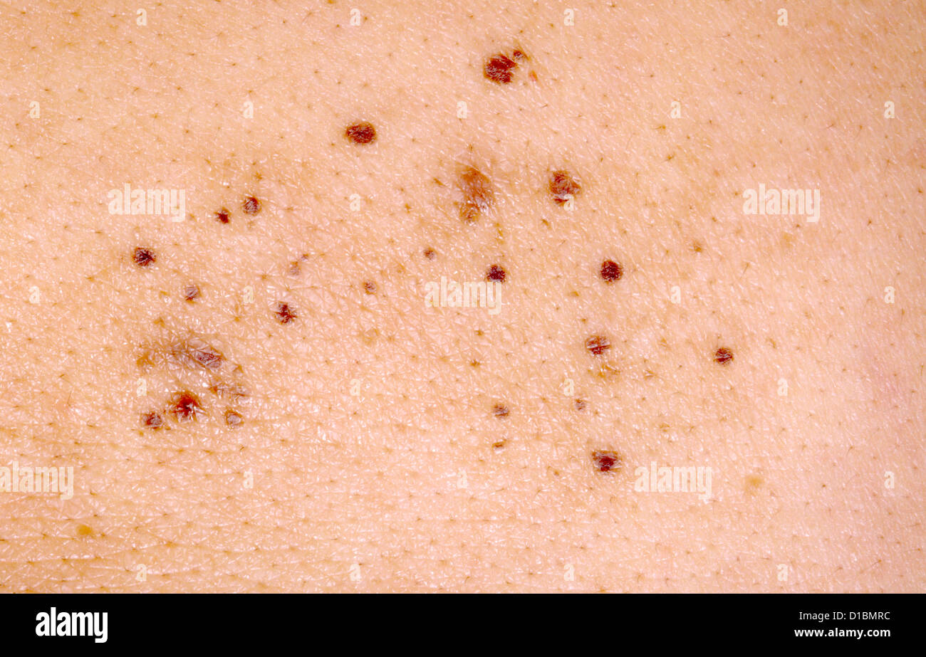 Nevus spilus hi-res stock photography and images - Alamy