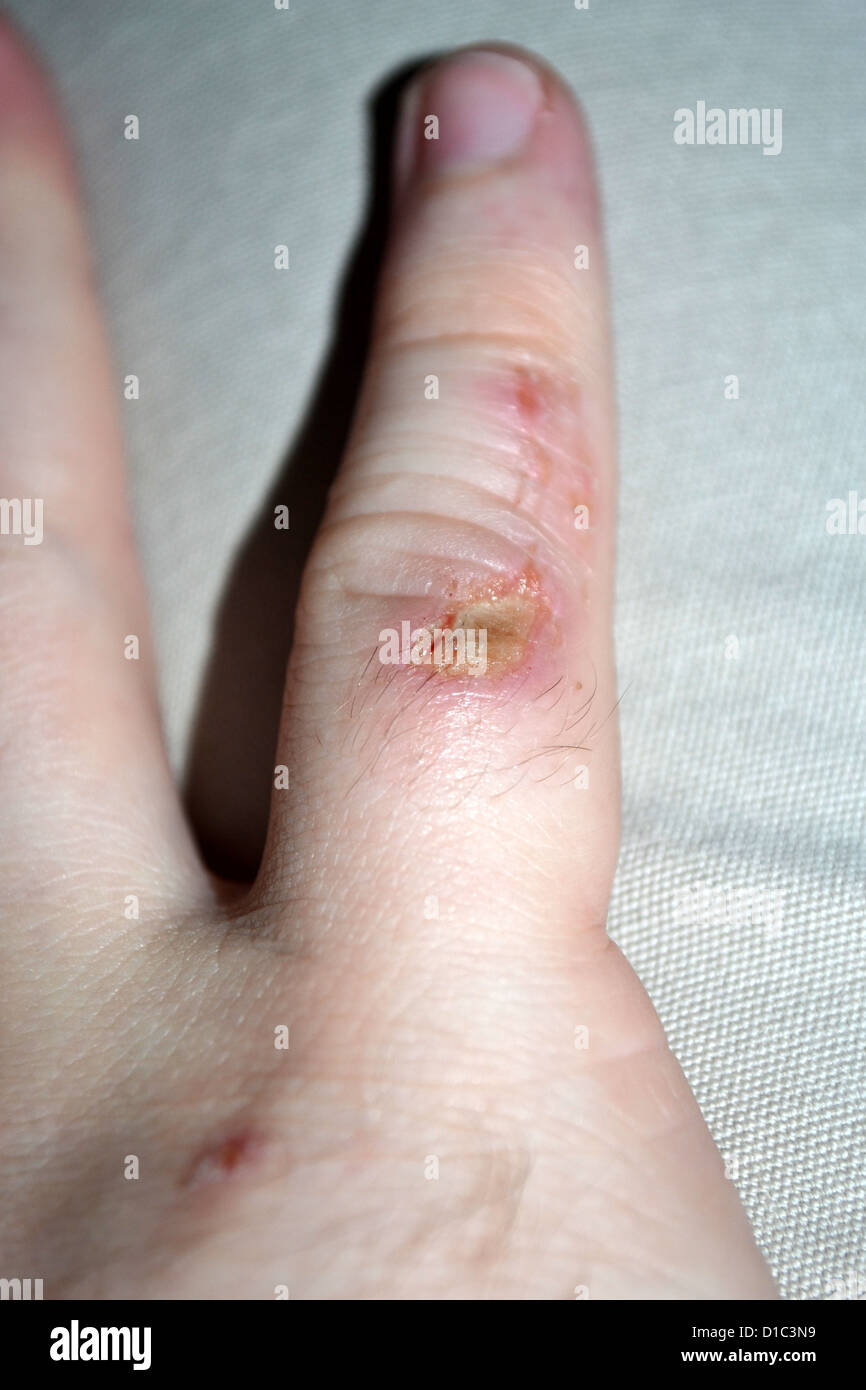 Pus cells hi-res stock photography and images - Alamy