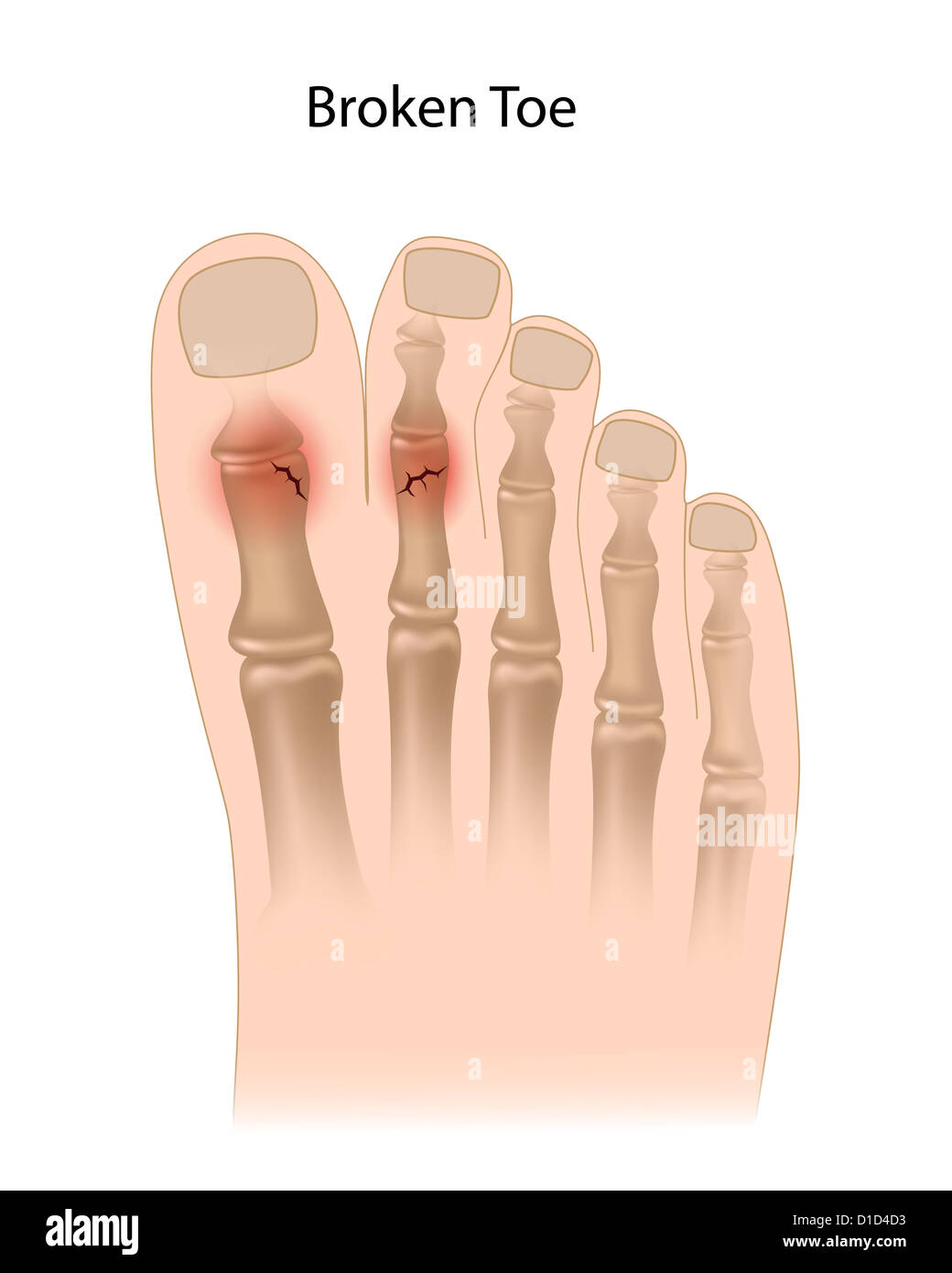 Big toe fracture hi-res stock photography and images - Alamy