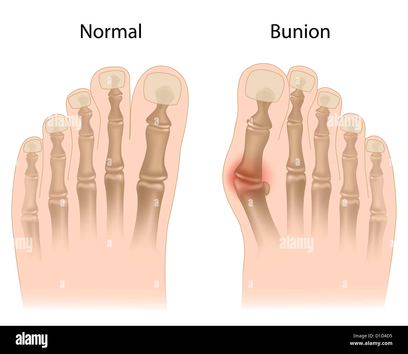 Hallux valgus illustration bunion hi-res stock photography and images ...