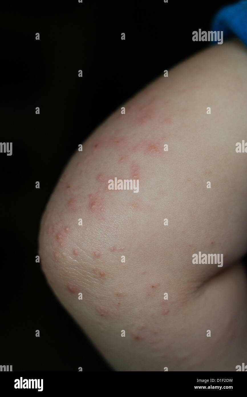 Rash Leg High Resolution Stock Photography and Images - Alamy