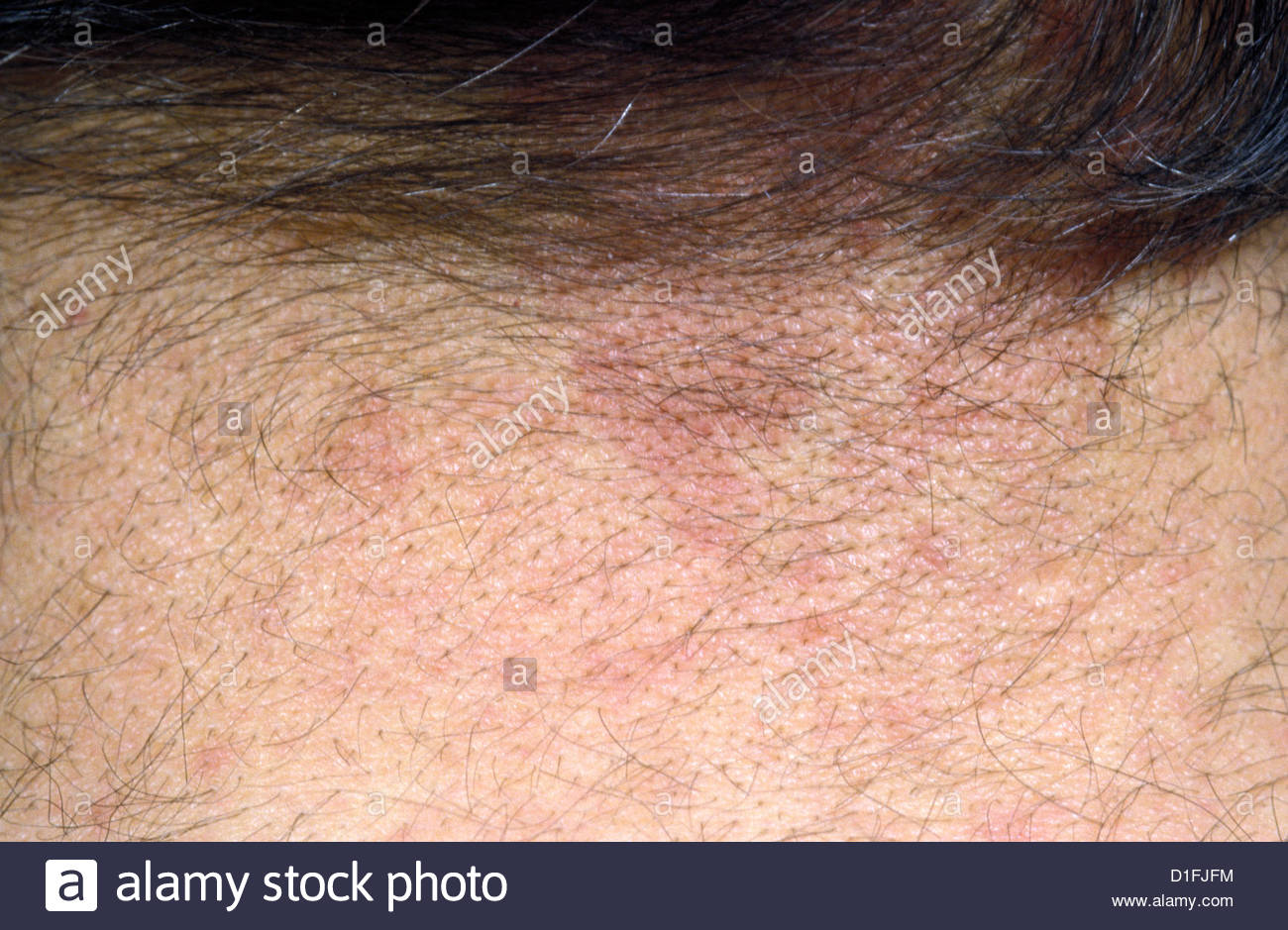 Staphylococcus Aureus Skin Stock Photos & Staphylococcus Aureus Skin ...