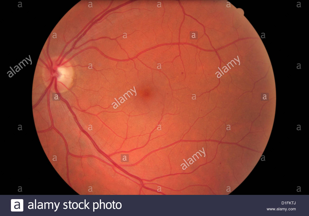 Signs Of Background Diabetic Retinopathy at Lily Bloom blog