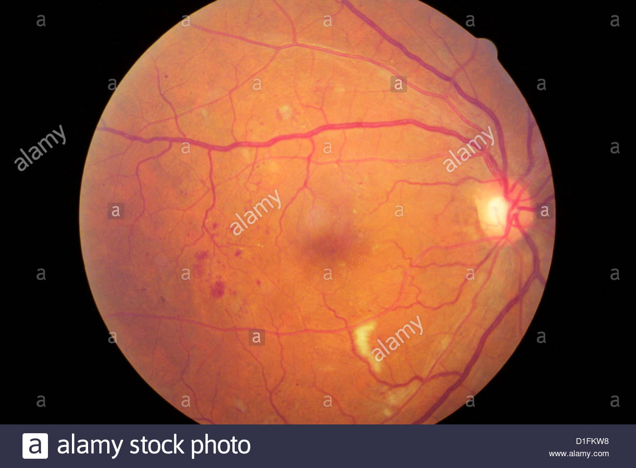 PRE-PROLIFERATIVE DIABETIC RETINOPATHY NSC GRADE R2 Stock Photo ...