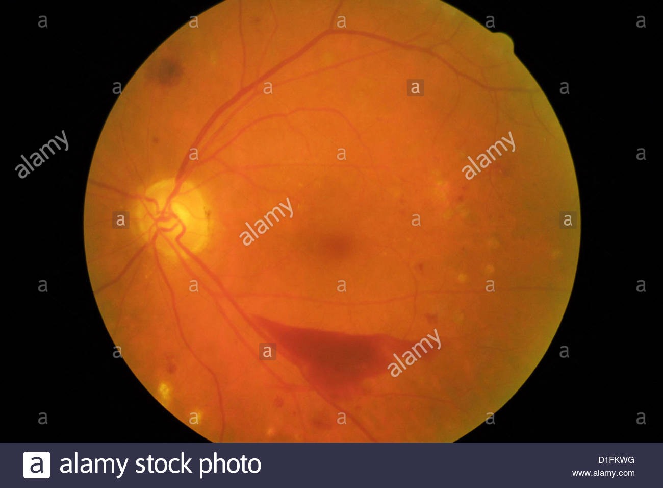 Diabetic Retinopathy Stock Photos & Diabetic Retinopathy Stock Images ...