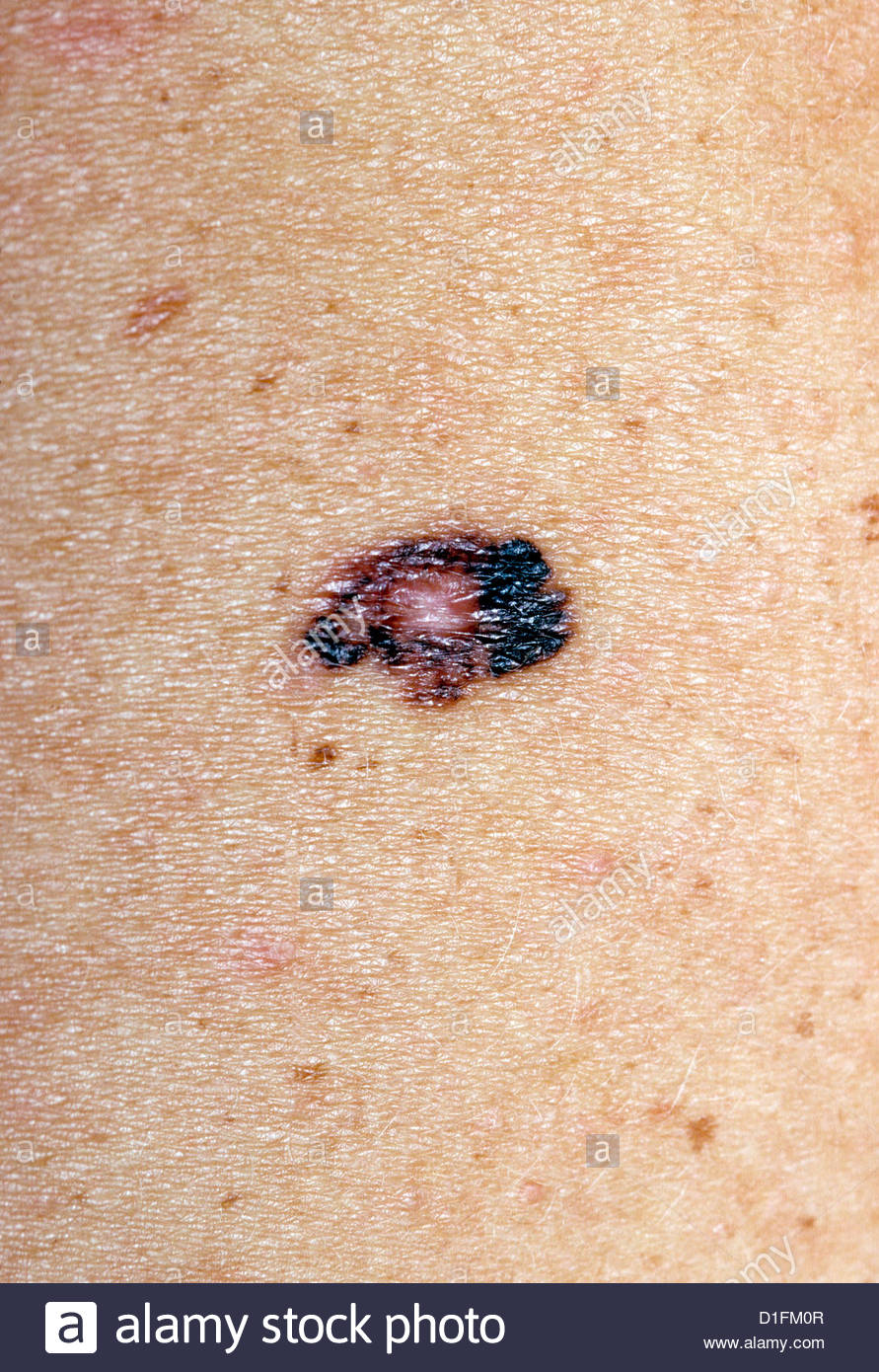 SUPERFICIAL SPREADING MALIGNANT MELANOMA Stock Photo, Royalty Free ...