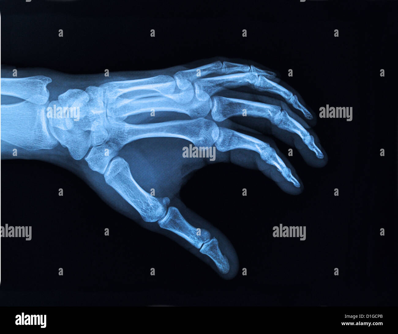 Roentgen hand x ray hi-res stock photography and images - Alamy