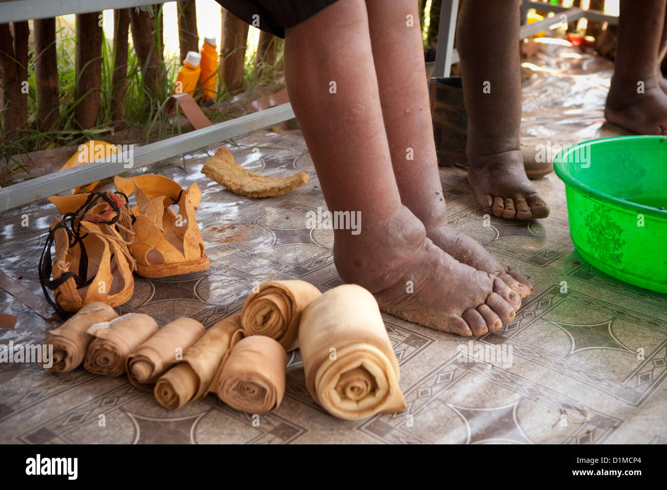 Elephantiasis Images