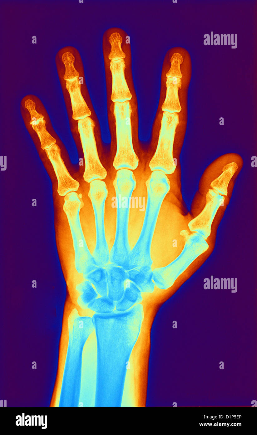Arthritic hand, X-ray Stock Photo - Alamy