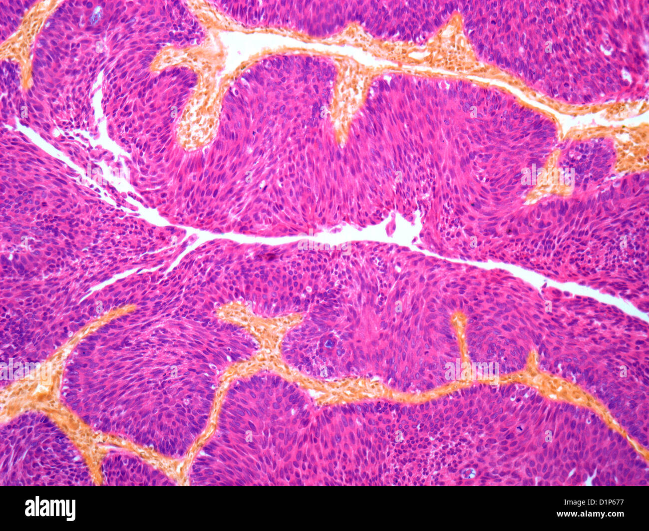 Bladder cancer light micrograph hi-res stock photography and images - Alamy