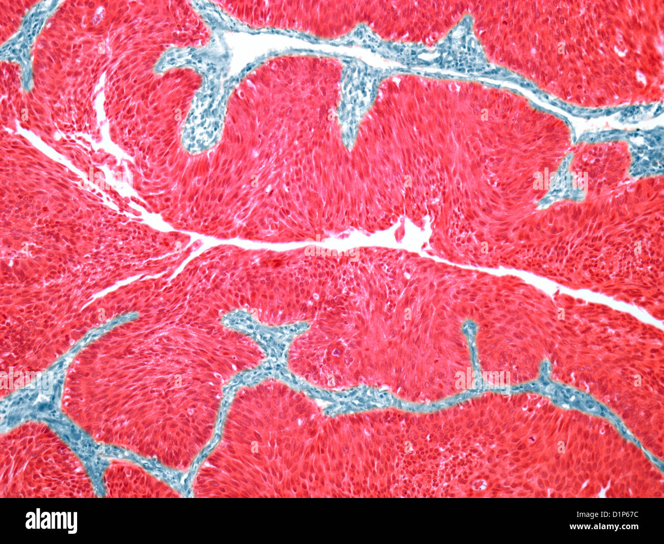 Human cancer cell light micrograph hi-res stock photography and images ...