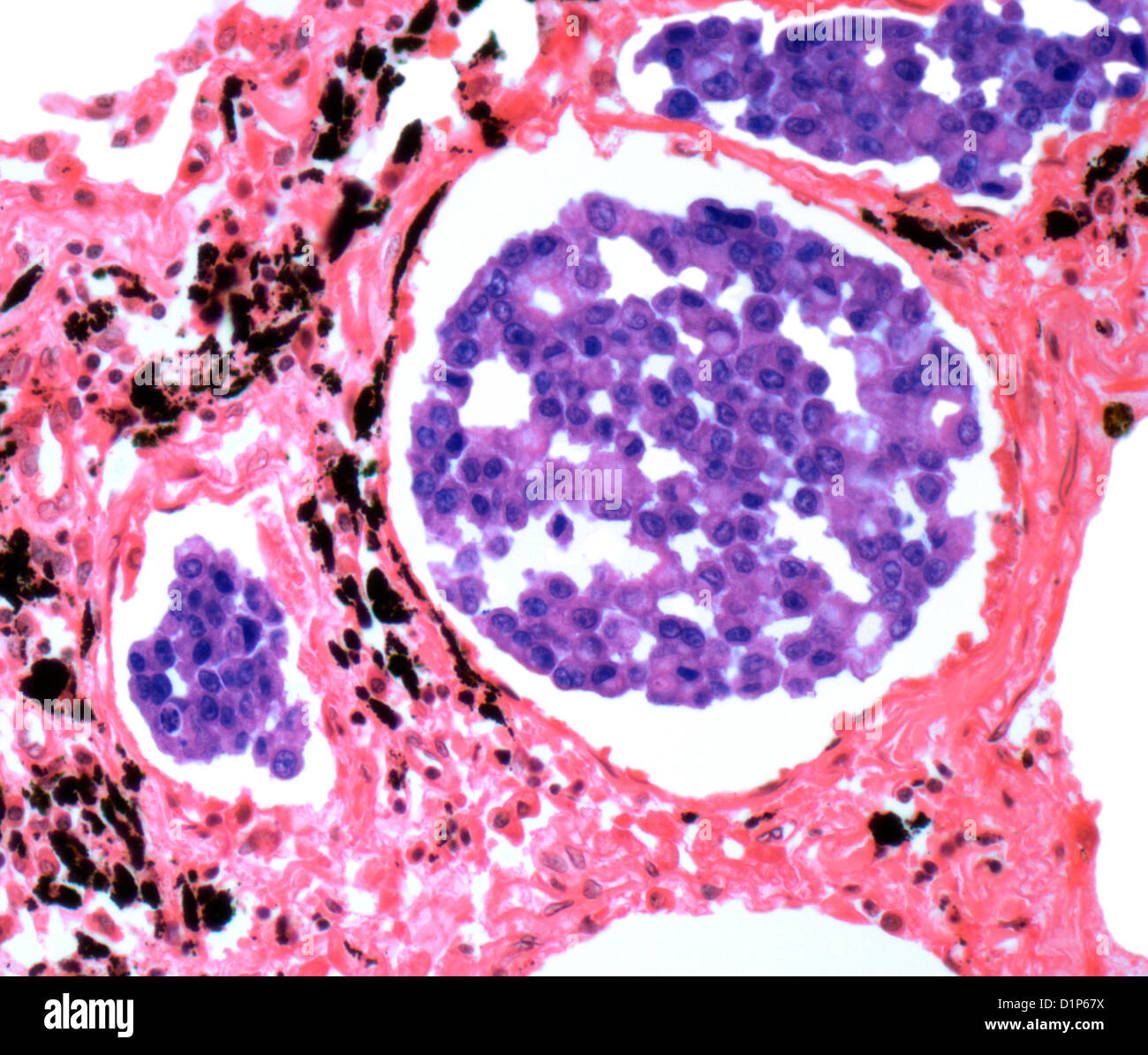 Lung with secondary carcinoma hi-res stock photography and images - Alamy