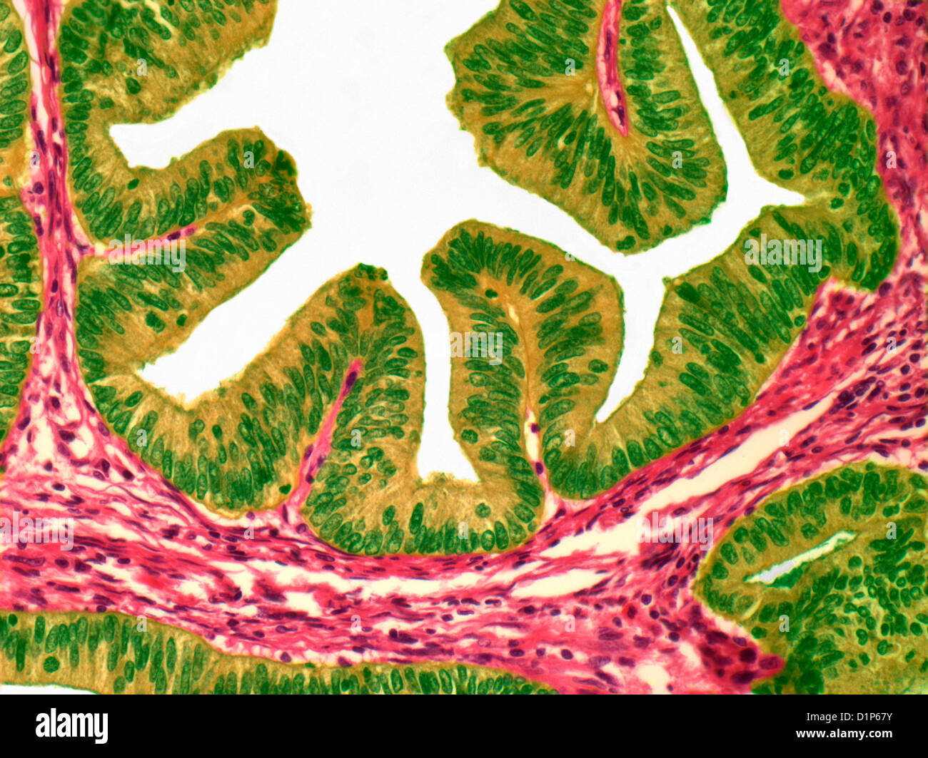 Uterine cancer light micrograph hi-res stock photography and images - Alamy