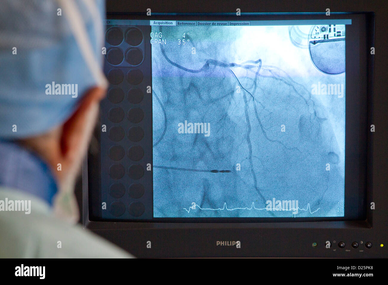 Coronary angiography hi-res stock photography and images - Alamy