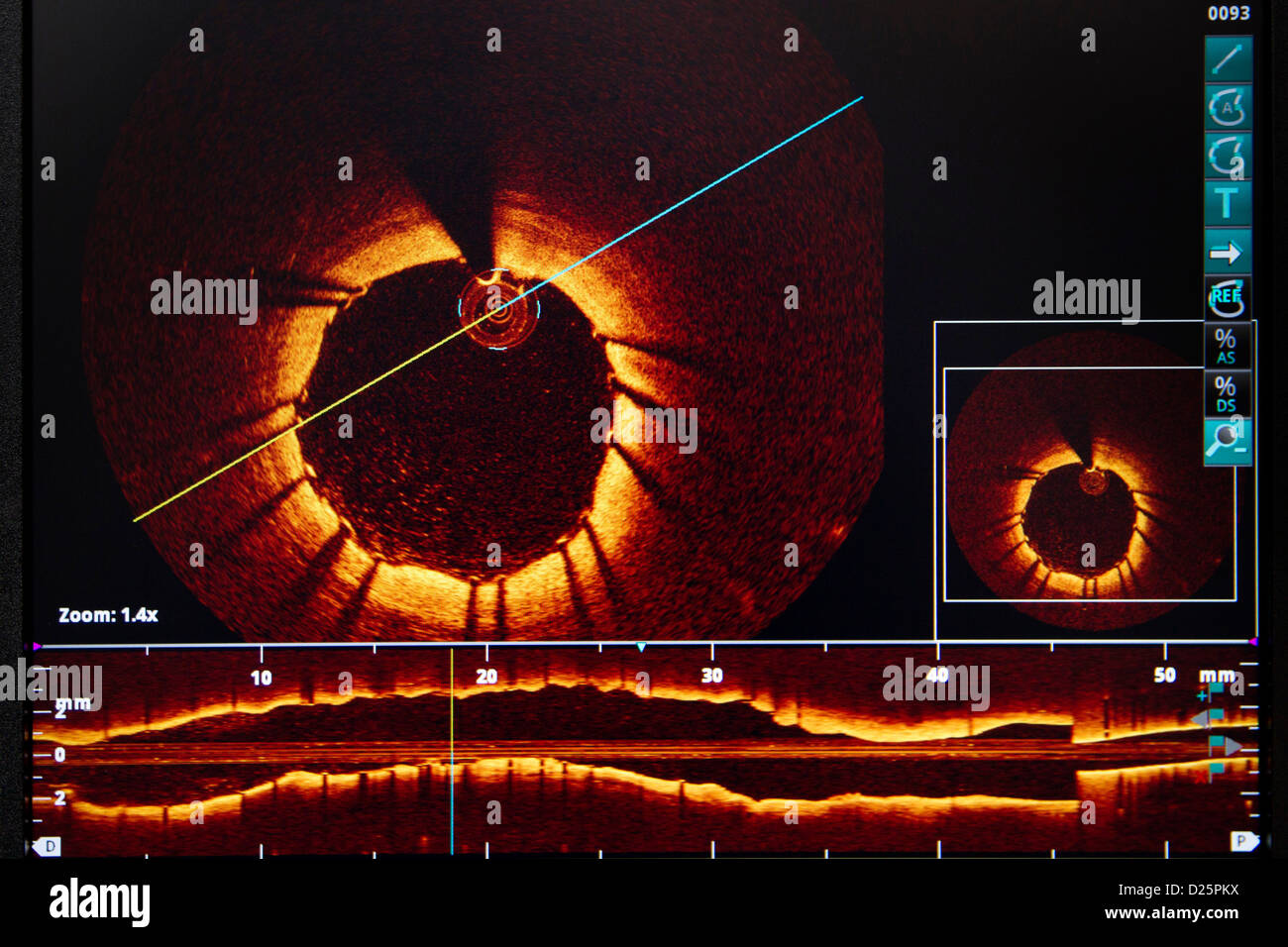 Optical coherence tomography oct hi-res stock photography and images ...