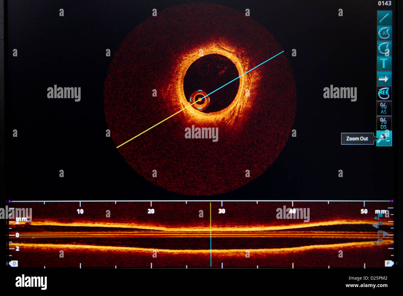 Coronary surgery hi-res stock photography and images - Alamy