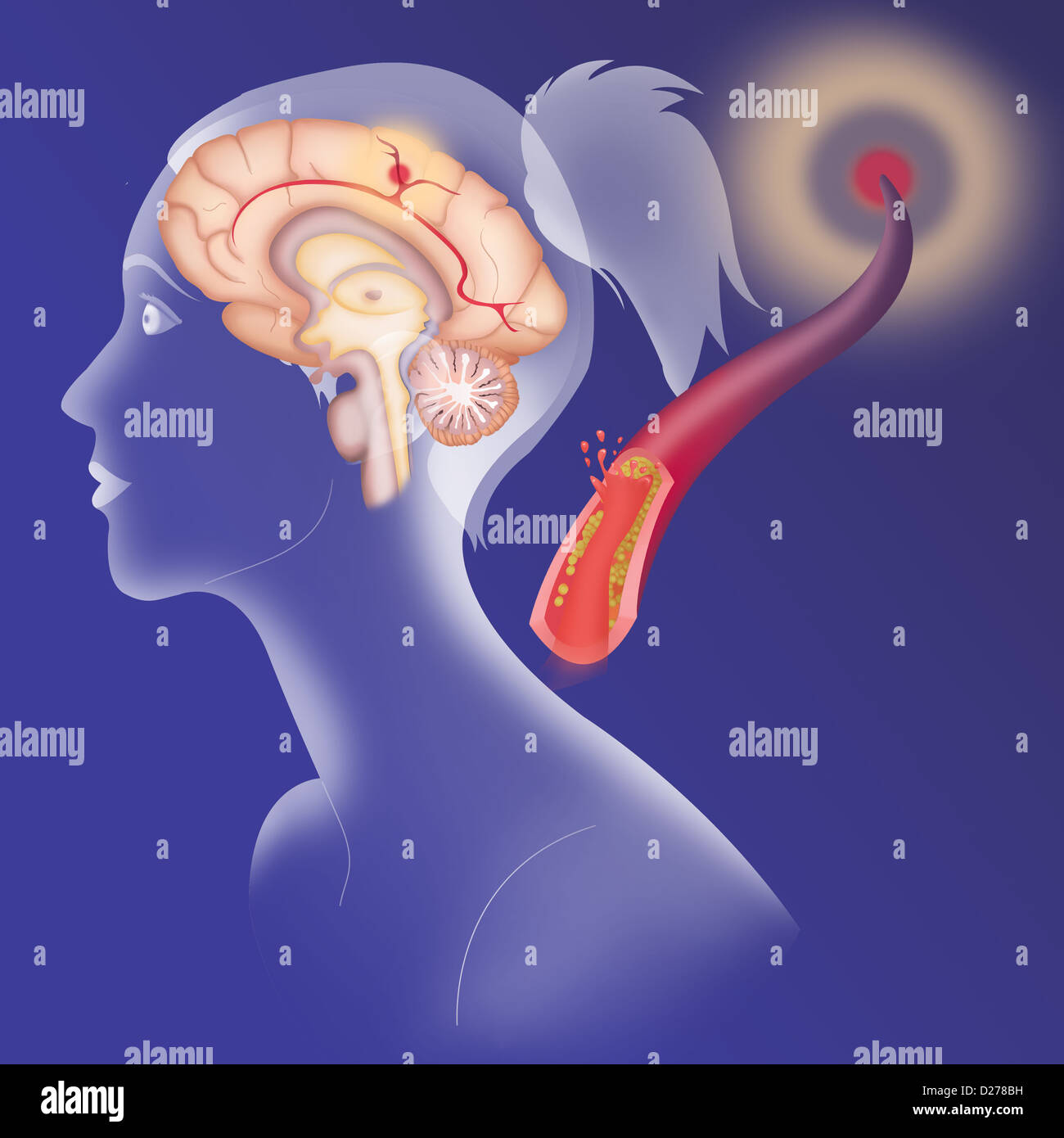 CEREBROVASCULAR NEUROL. DISEASE Stock Photo - Alamy
