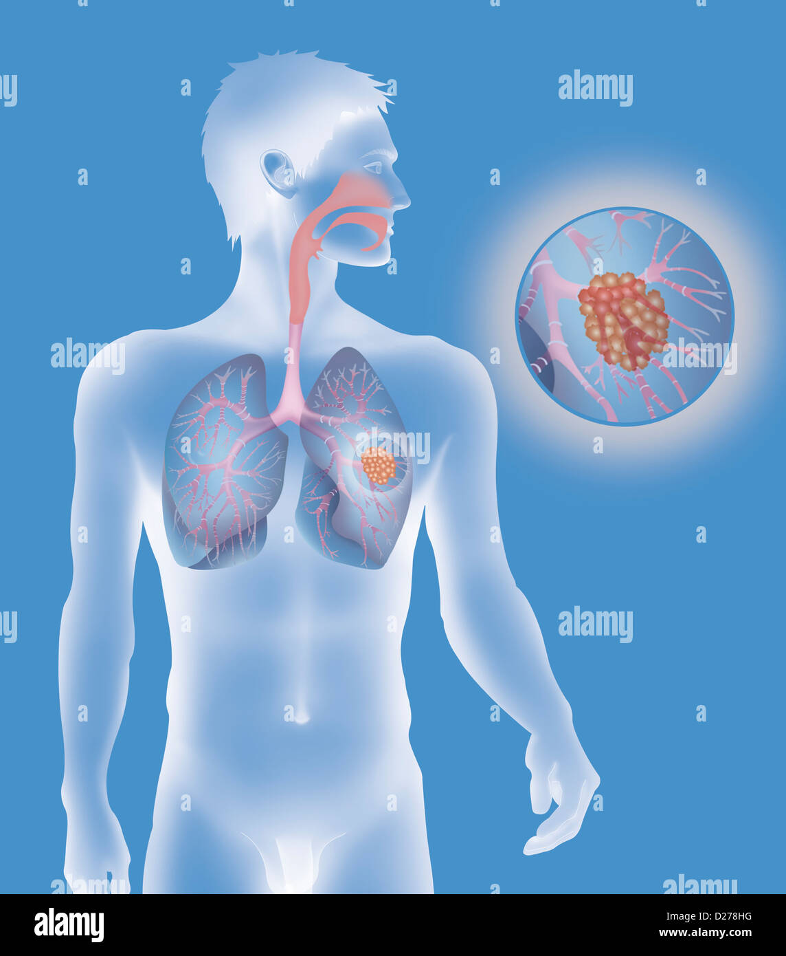 LUNG CANCER, DRAWING Stock Photo - Alamy