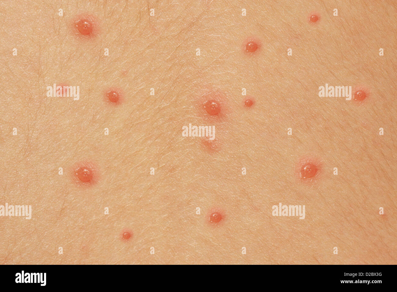Detail baby with chicken pox rash Stock Photo - Alamy