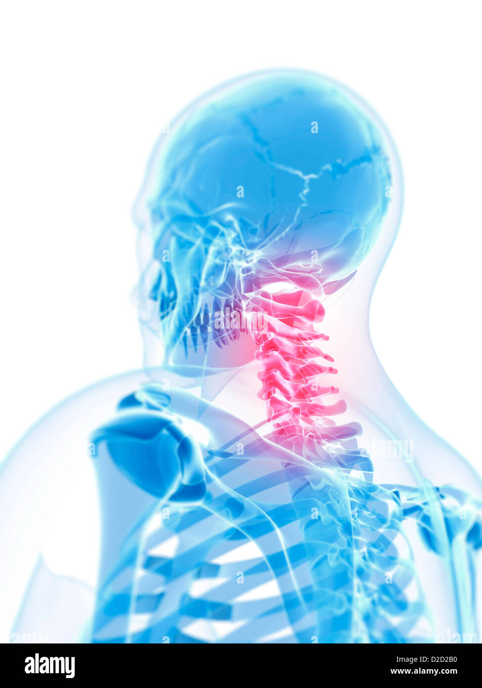 Neck pain conceptual computer artwork Stock Photo - Alamy