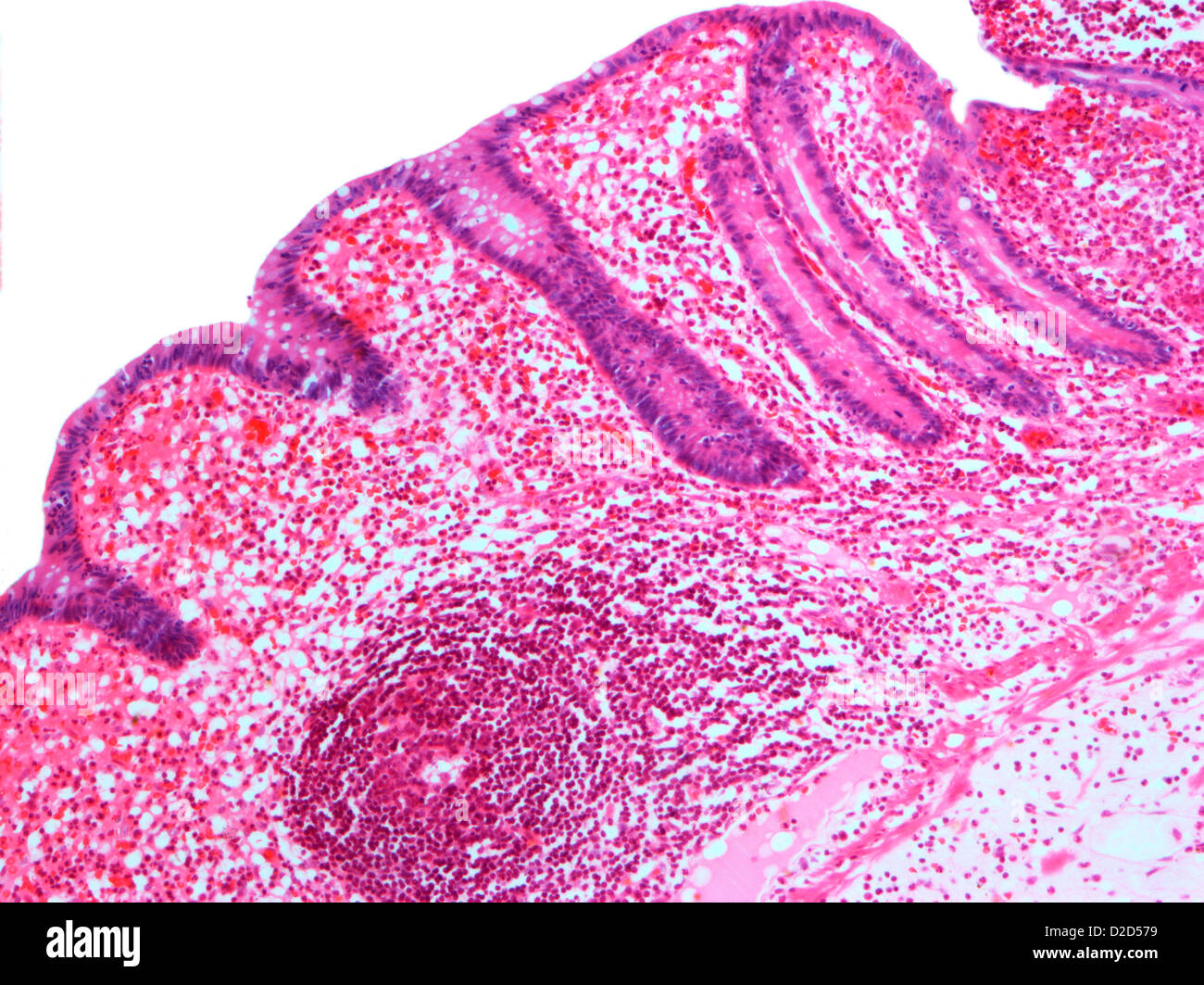 Appendicitis Light micrograph of a section through an inflamed appendix ...