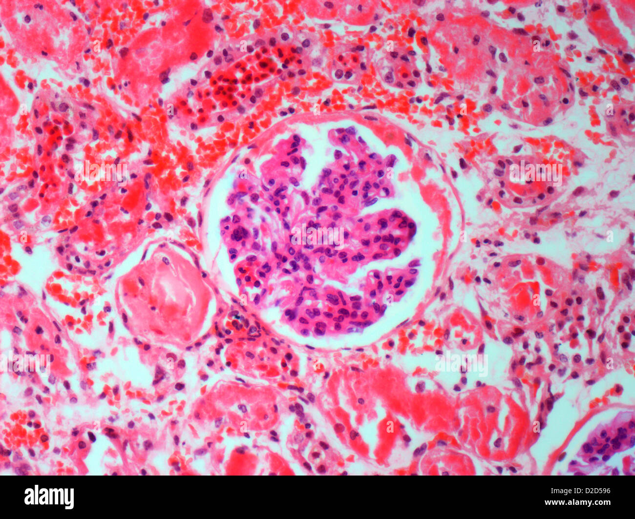 Kidney disease Light micrograph of a section through an inflamed kidney ...