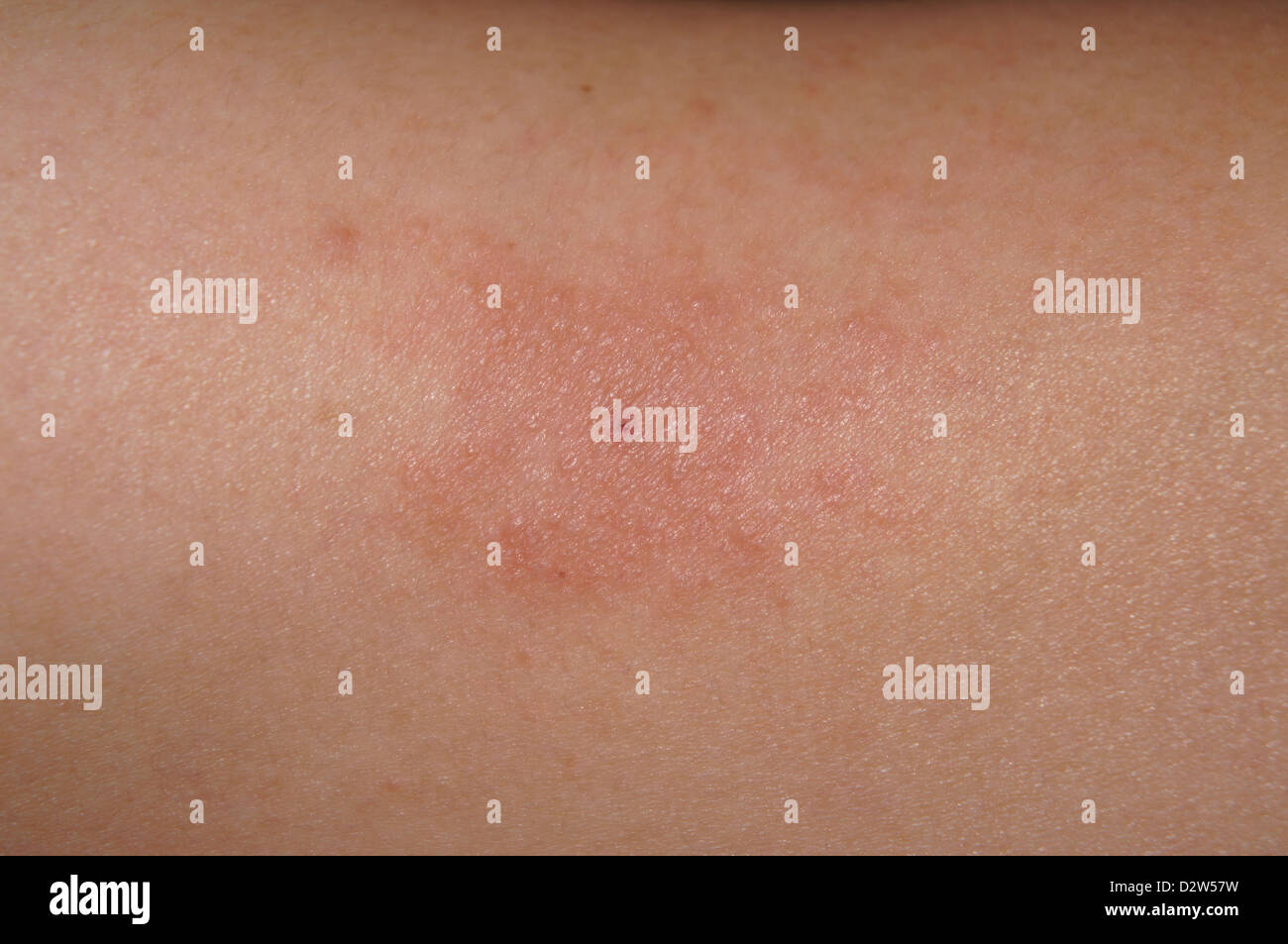 Skin rash hi-res stock photography and images - Alamy