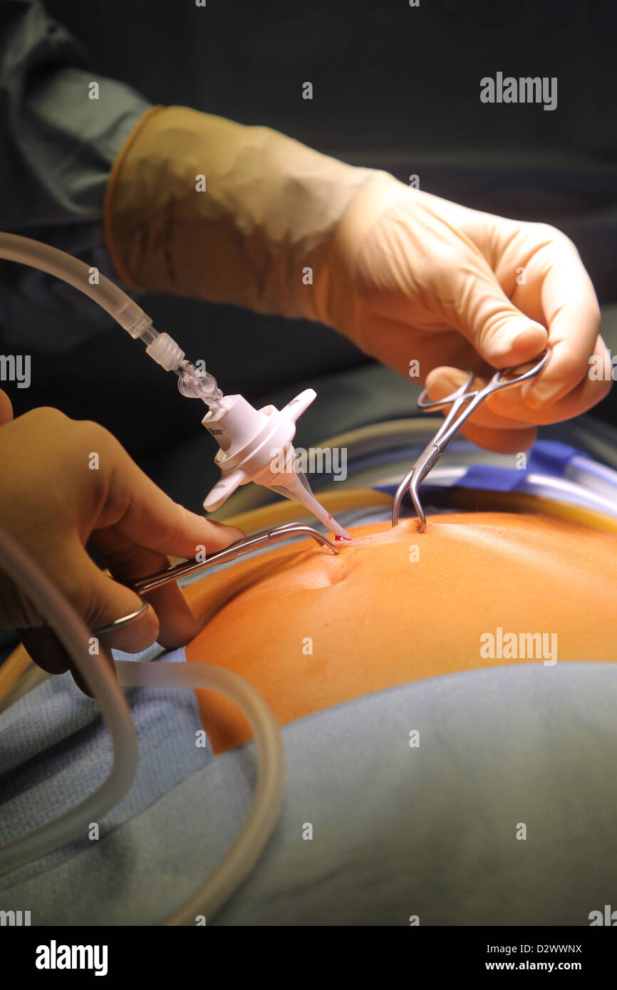 Insufflation hi-res stock photography and images - Alamy