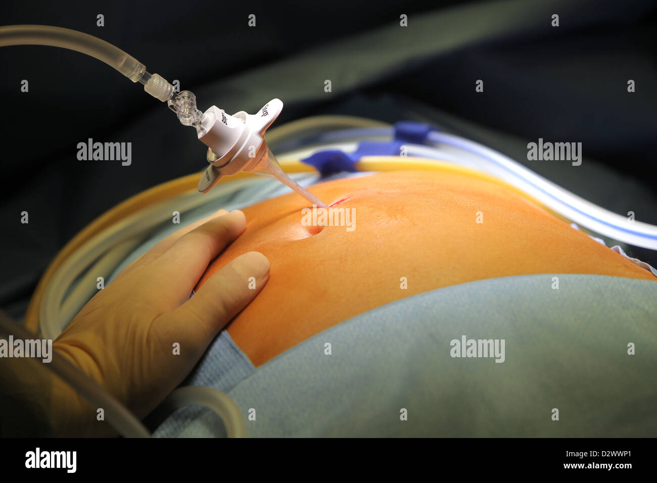 Insufflation hi-res stock photography and images - Alamy