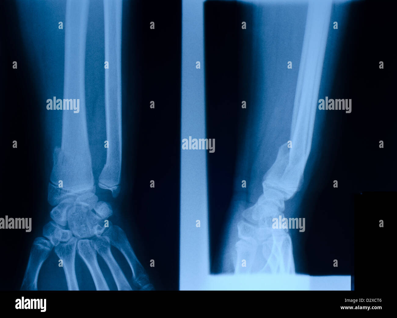 X ray film of distal radias fracture Stock Photo - Alamy