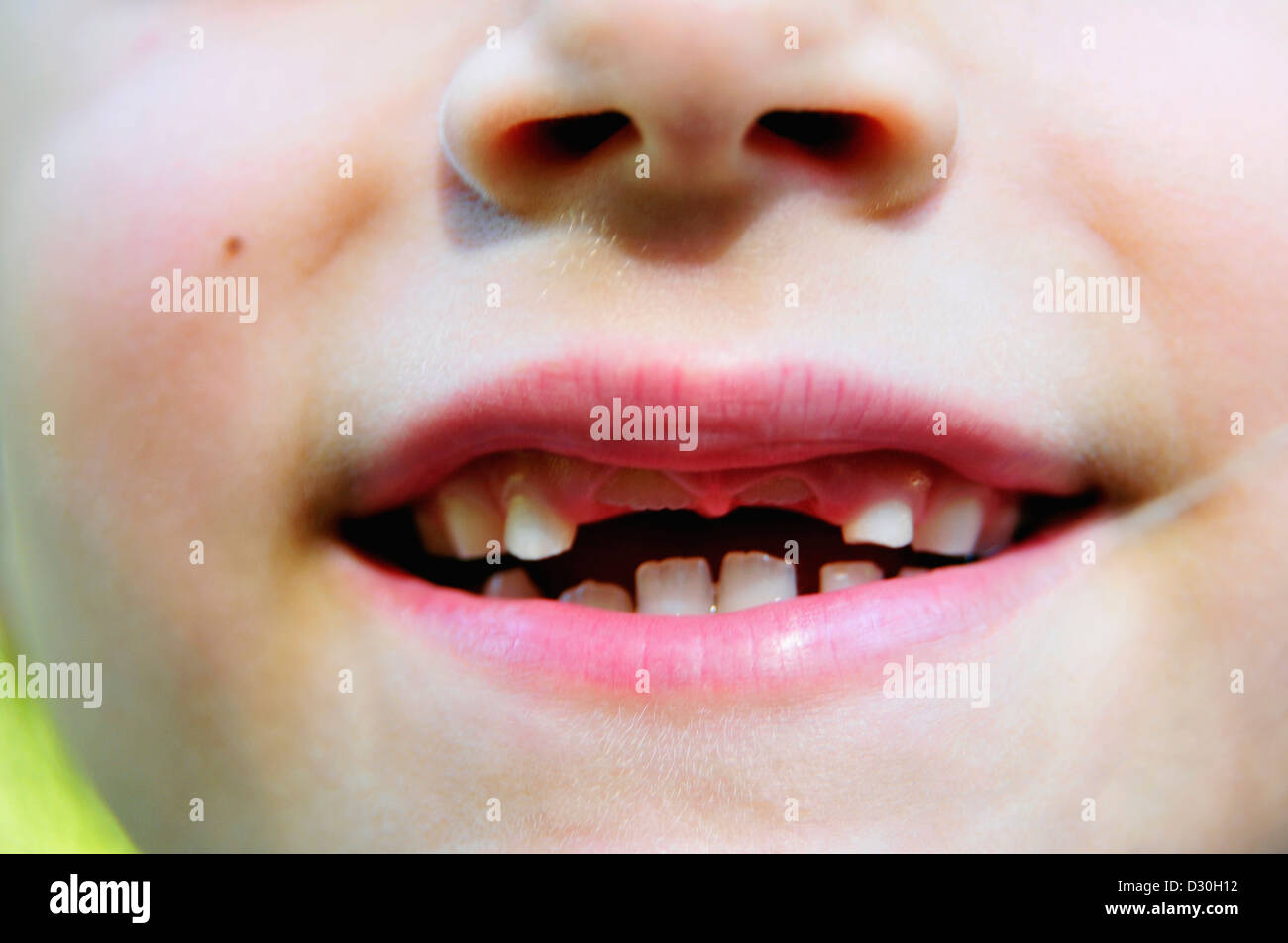 Missing Teeth Children High Resolution Stock Photography and Images - Alamy