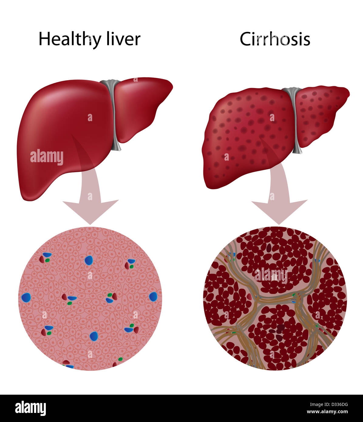 Liver cirrhosis drawing hi-res stock photography and images - Alamy