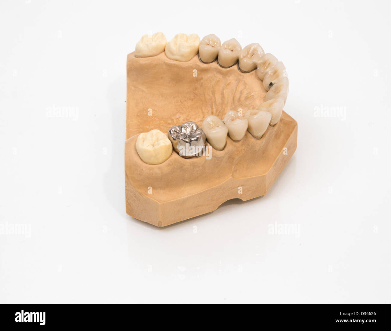 Dental mold hi-res stock photography and images - Alamy