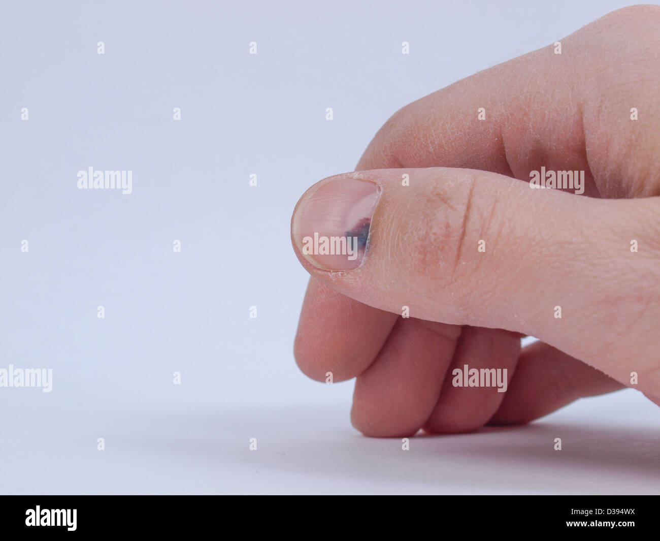 Subungual hematoma - collection of blood underneath fingernail (black ...